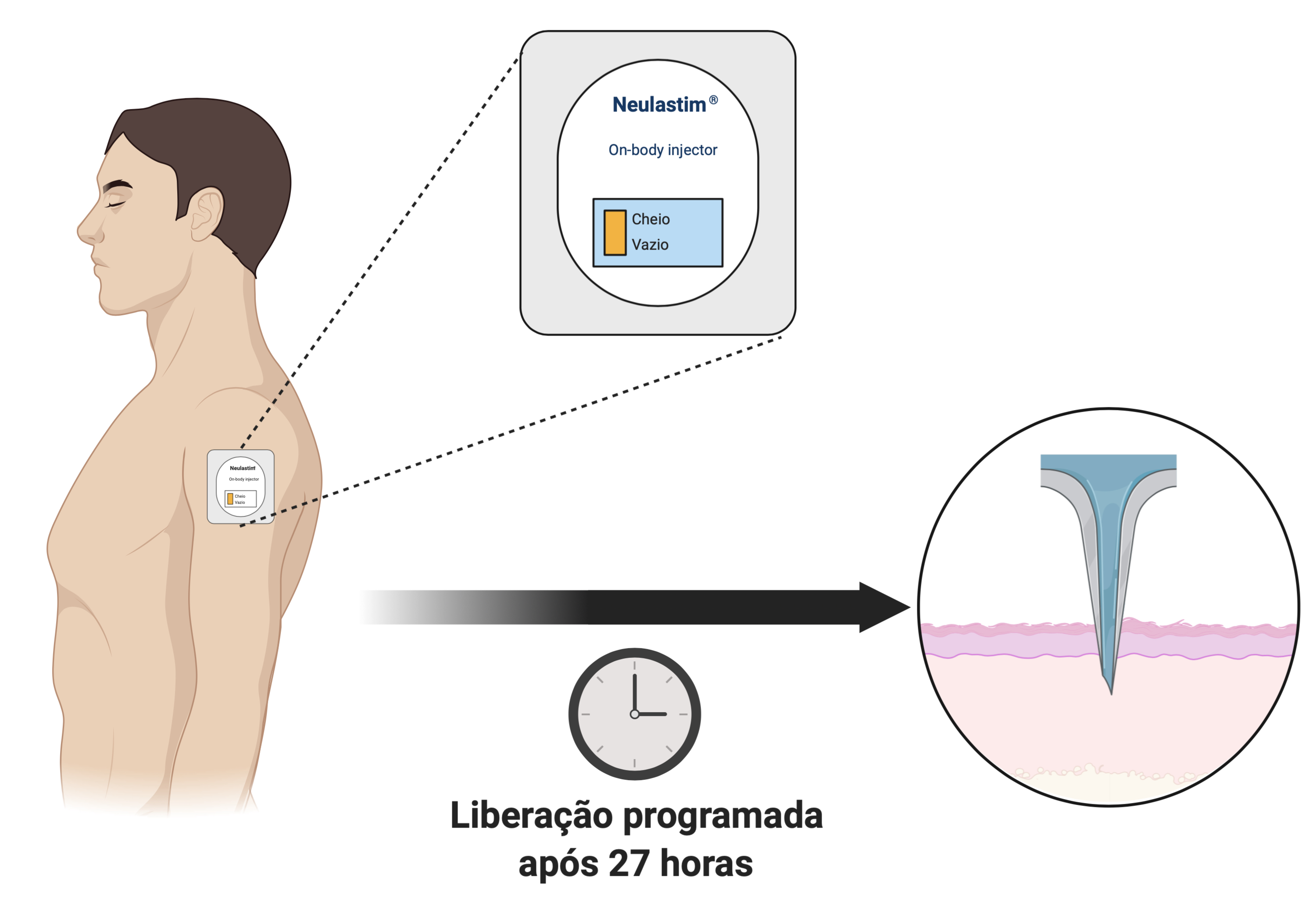 Dispositivo de administração programada de Neulastim® é aprovado no ...