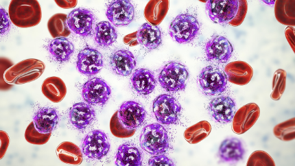 Tratamento da leucemia linfoide aguda sem o uso de quimioterapia ...